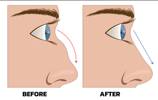 Best Rhinoplasty Surgeon Dallas, Southlake, Plano & Ft Worth, TX | Near Me