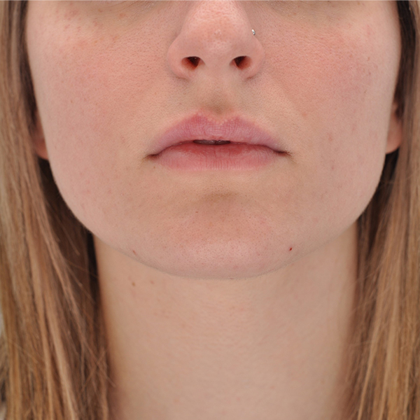 Botox Dermal Fillers Case 3444 Dr Ali Abtahi Amor Propio 3426
